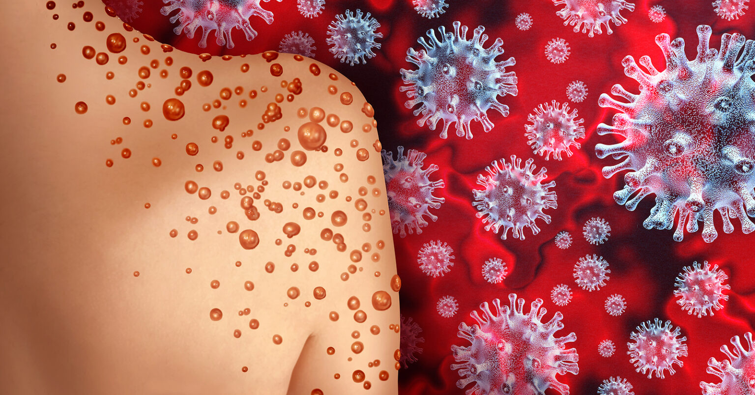Monkeypox Is Now A Global Health Emergency BioEdge monkeypox-is-now-a-global-health-emergency-bioedge